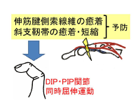 手指中節骨骨折のMP・DIP関節への影響｜PT-OT-STチャンネル オンラインジャーナル